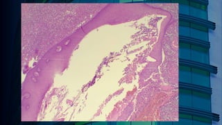 Histopathology of Pilonidal Sinus | PPTX