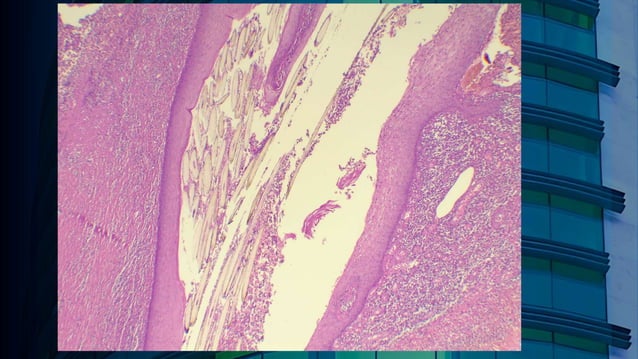 Histopathology of Pilonidal Sinus | PPTX | Ear, Nose and Throat ...