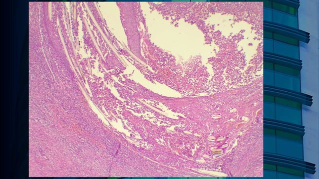 Histopathology of Pilonidal Sinus | PPTX | Ear, Nose and Throat ...