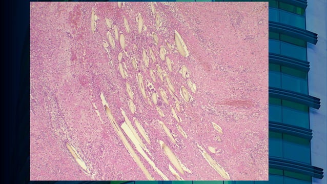 Histopathology of Pilonidal Sinus | PPTX | Ear, Nose and Throat ...