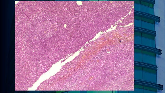 Histopathology of Pilonidal Sinus | PPTX | Ear, Nose and Throat ...