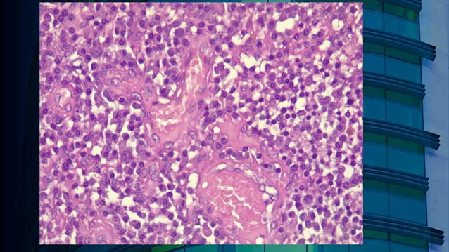 Histopathology of Pilonidal Sinus | PPTX | Ear, Nose and Throat ...