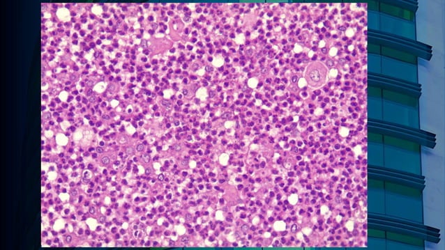 Histopathology of Pilonidal Sinus | PPTX | Ear, Nose and Throat ...