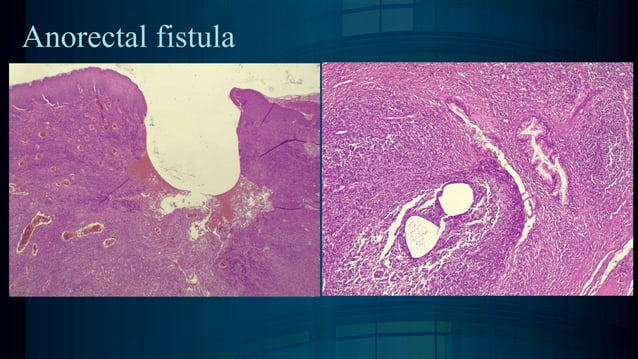 Histopathology of Pilonidal Sinus | PPTX | Ear, Nose and Throat ...