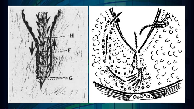 Histopathology of Pilonidal Sinus | PPTX | Ear, Nose and Throat ...
