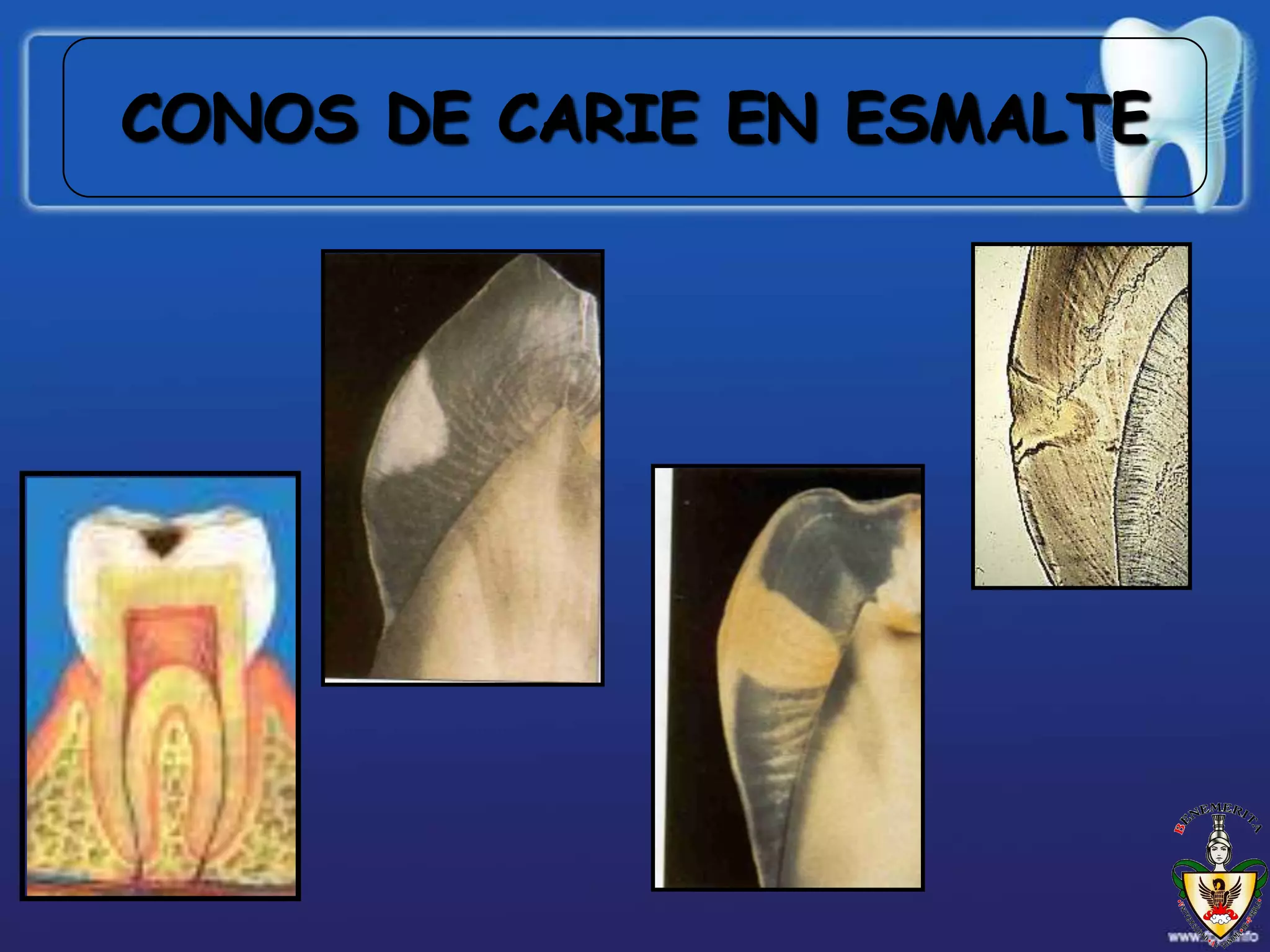 Histopatologia de la caries