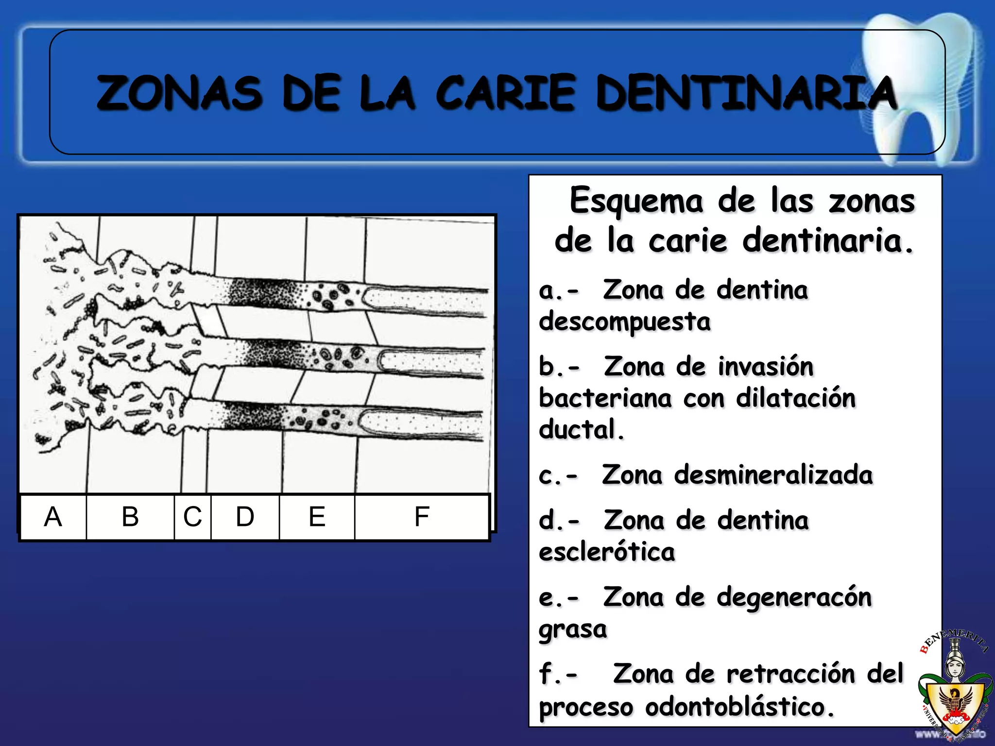 Histopatologia de la caries