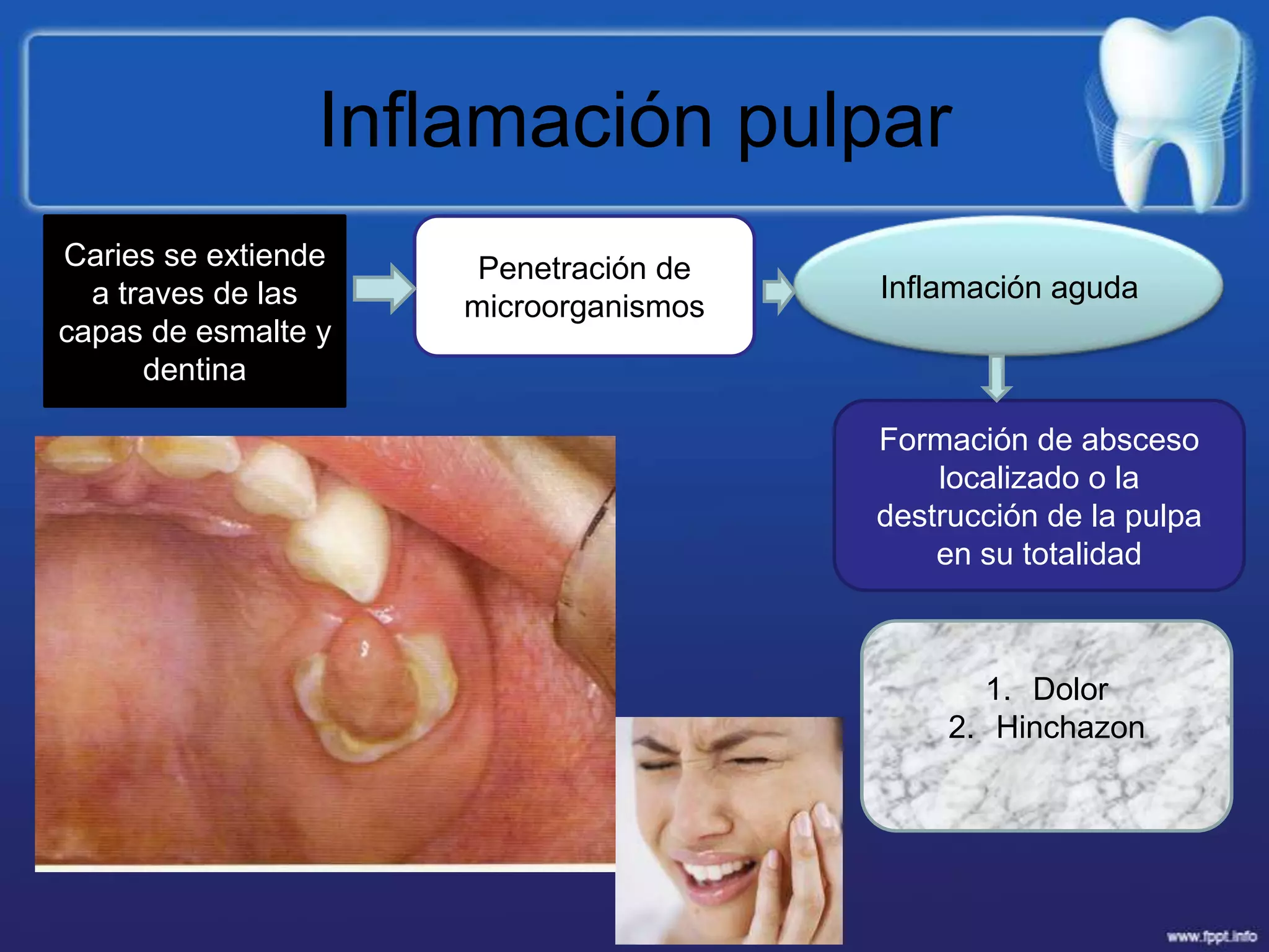 Histopatologia de la caries