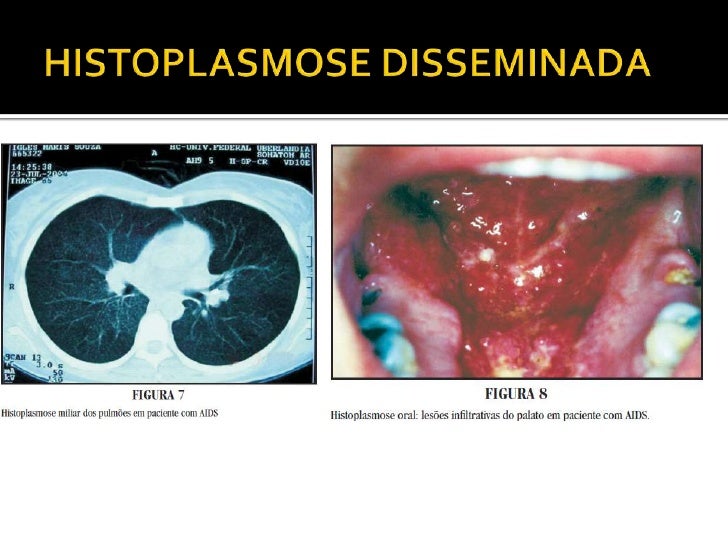 Histoplasmose