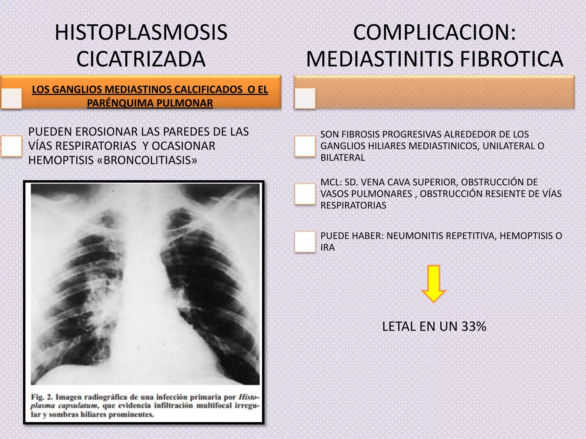 Histoplasmosis | PPTX
