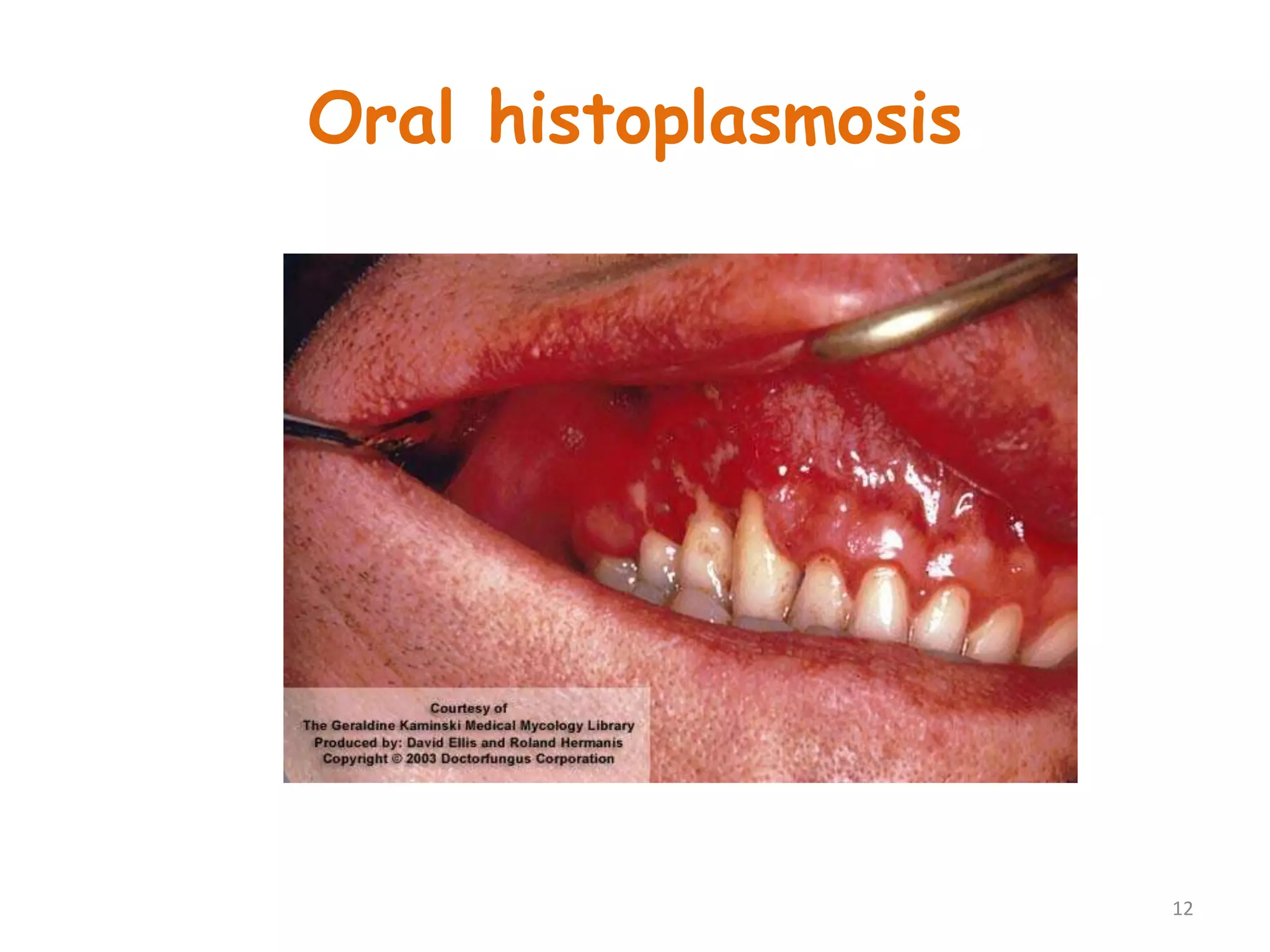 Histoplasmosis | PPTX
