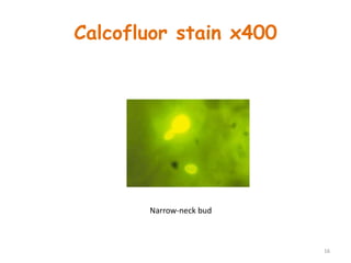 Histoplasmosis | PPTX