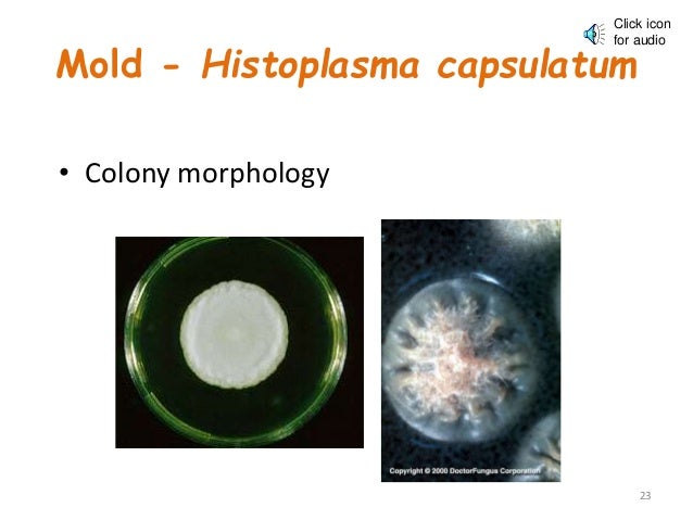Histoplasmosis