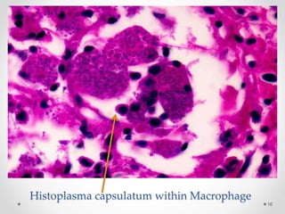 Histoplasma Capsulatum Macrophage