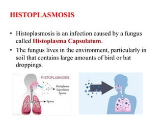 Ppt Histoplasma Capsulatum And Histoplasmosis Powerpoint Presentation