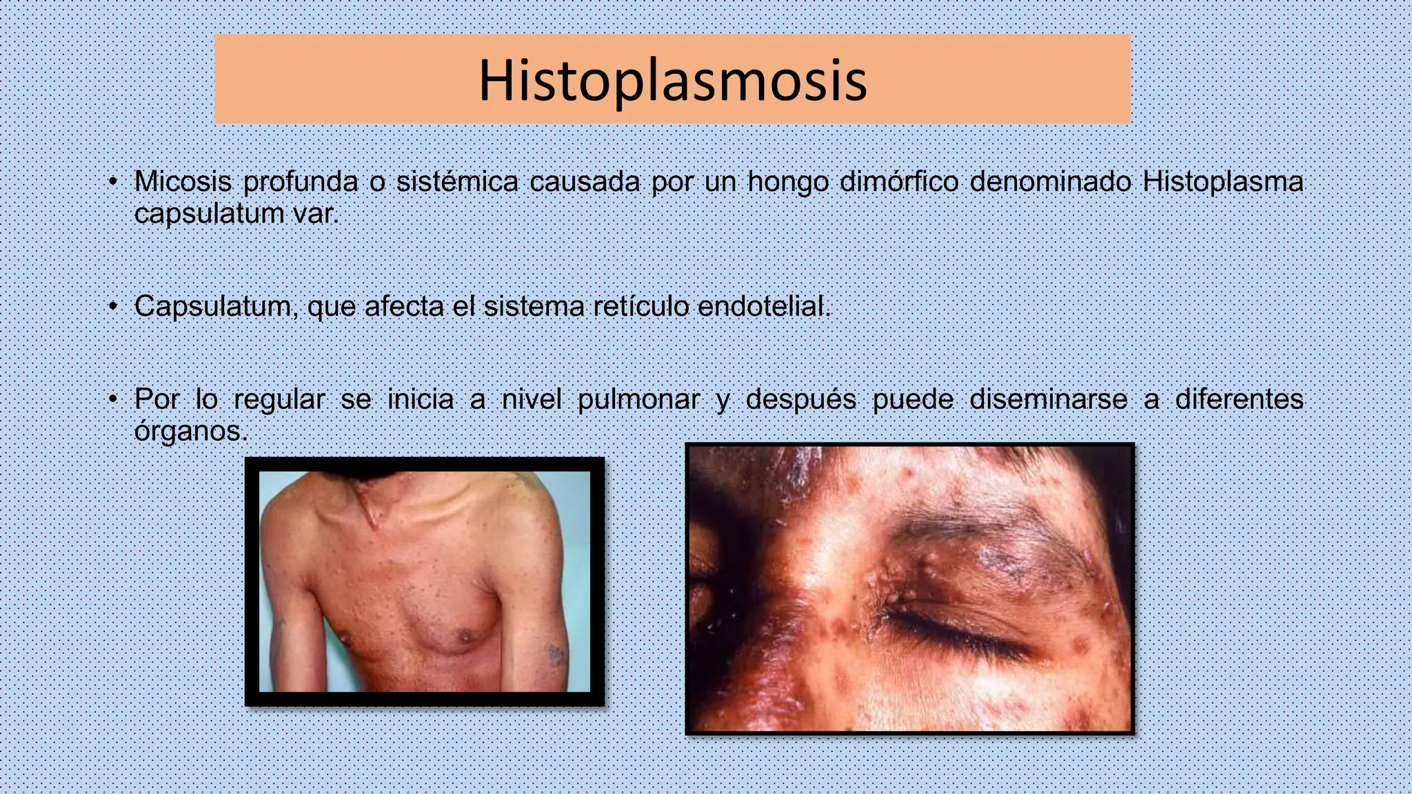 histoplasmosis micologia Médica Medicina.pptx