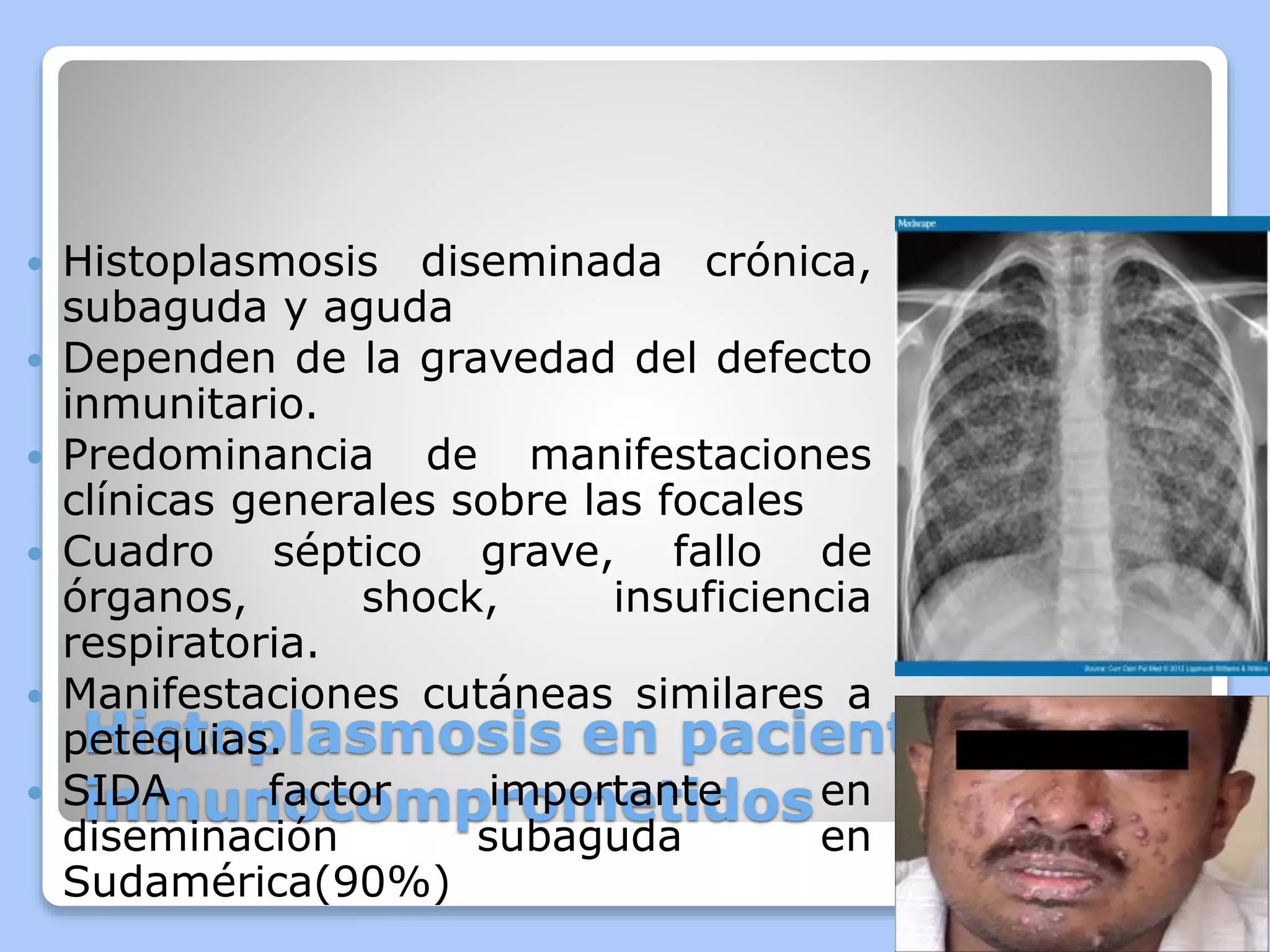 Histoplasmosis en pacientes inmunocomprometidos | PPT