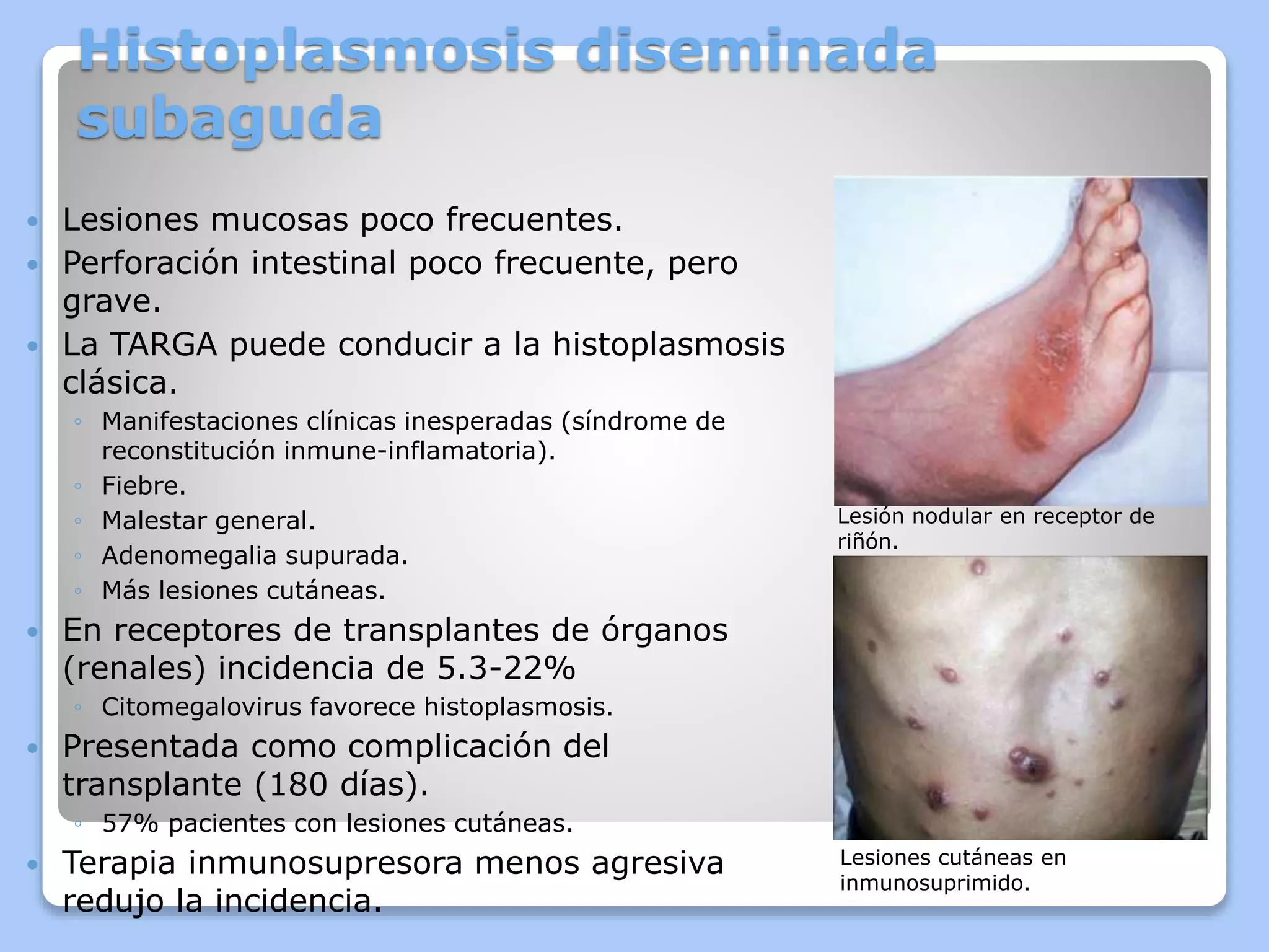 Histoplasmosis en pacientes inmunocomprometidos | PPT