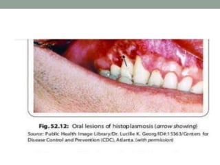 Histoplasmosis | | Systematic mycoses | | | PPT