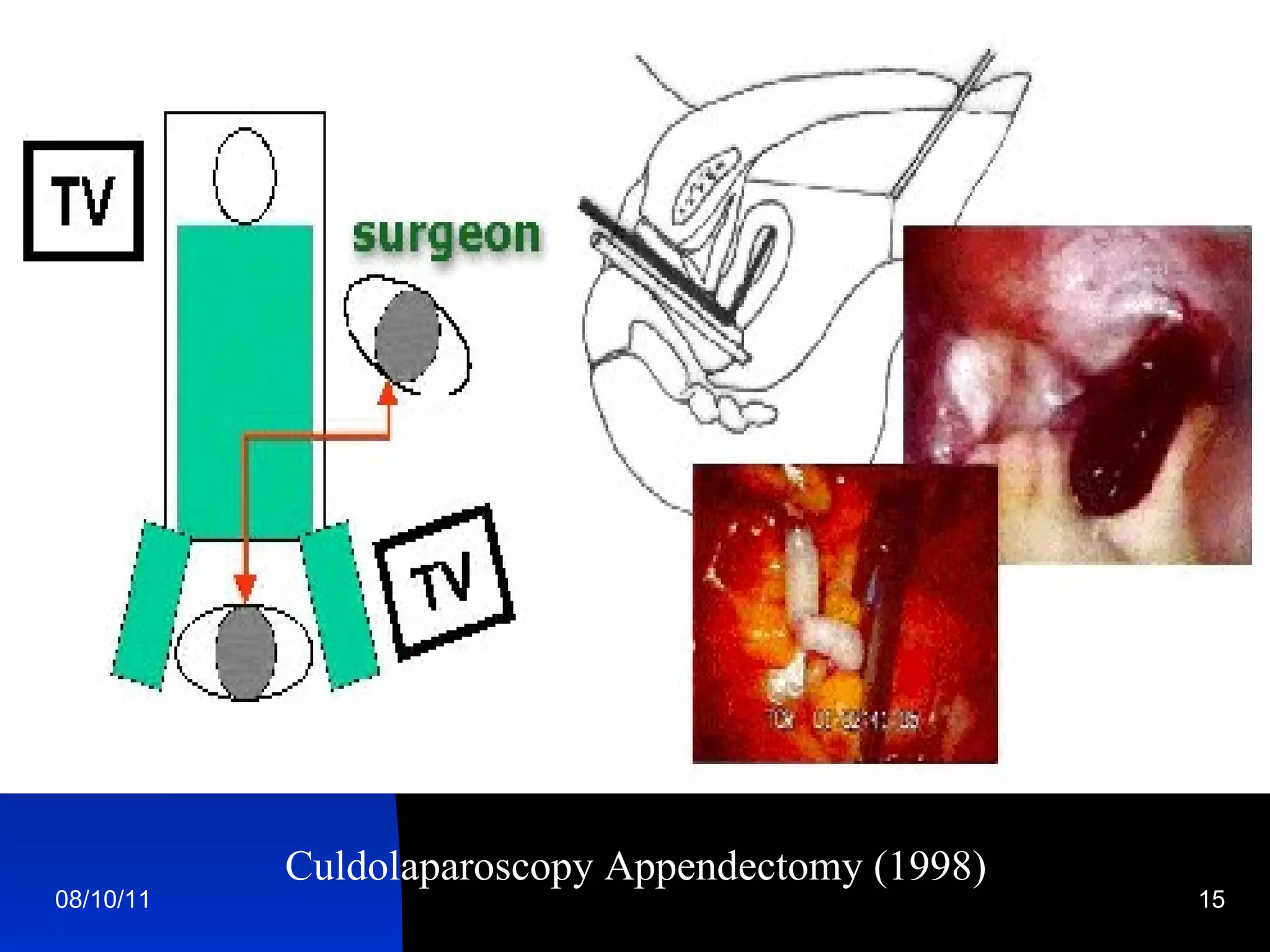 Historia de la Cirugia Endoscopica Transvaginal por Orificios Naturales ...