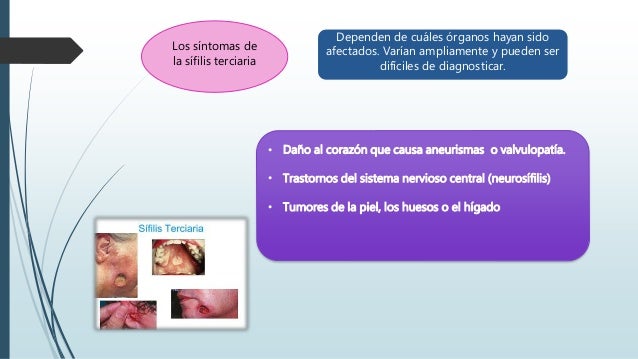 Historia de la sifilis
