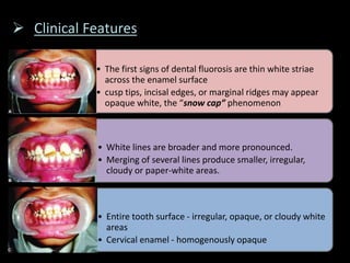 HISTORY & MECHANISM OF ACTION SYSTEMIC FLUORIDES.pptx