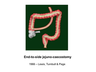 History of bariatric surgery | PPTX