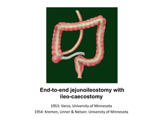 History of bariatric surgery | PPTX