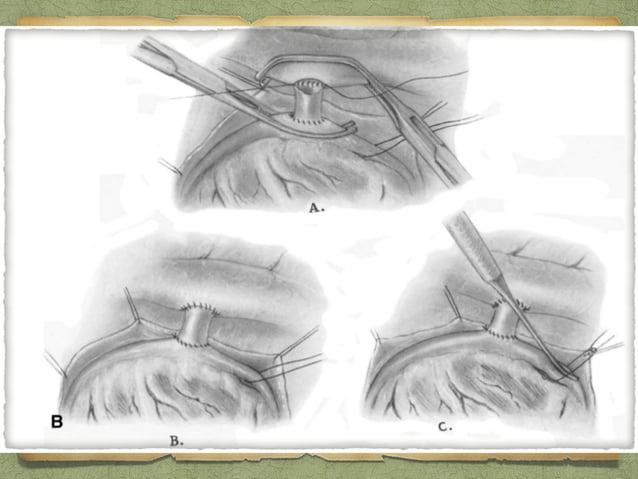 A brief History of Coronary Artery Bypass Grafting (CABG) | PDF
