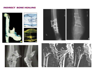 History of fracture fixation part 1 | PPTX