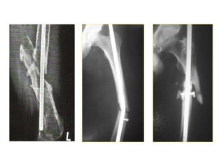 History of fracture fixation part 1 | PPTX
