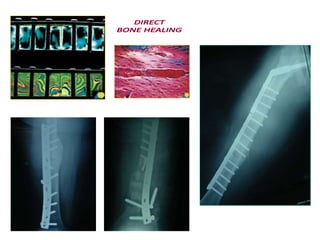 History of fracture fixation part 1 | PPTX