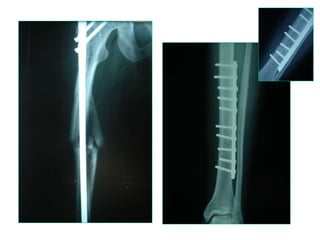 History of fracture fixation part 1 | PPTX