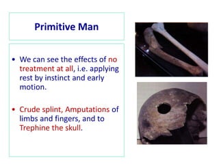 History of fracture fixation part 1 | PPTX