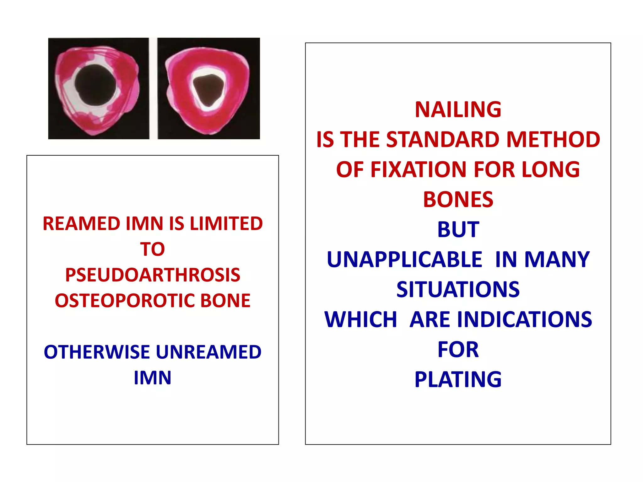 History of fracture fixation part 2 | PPTX
