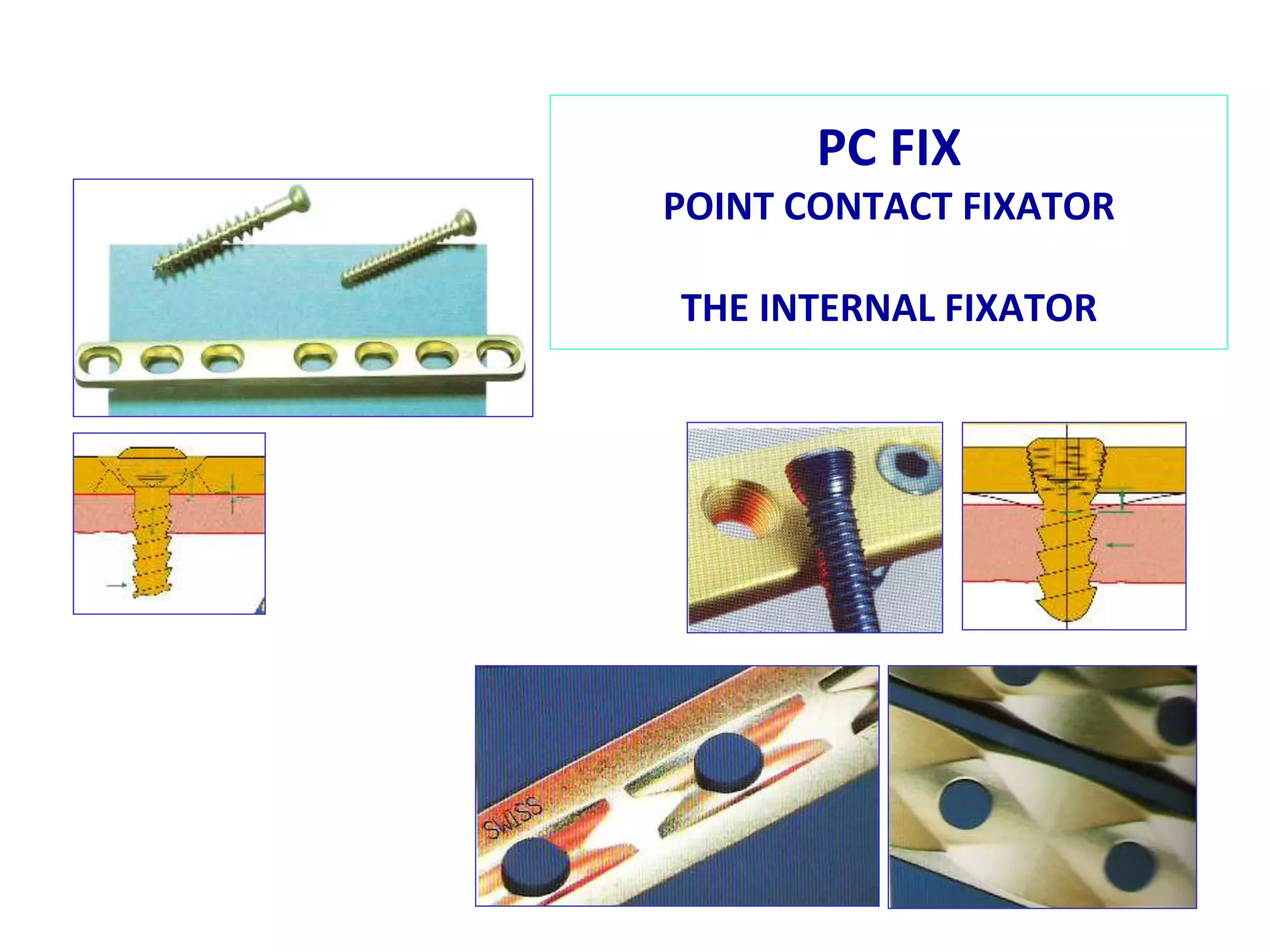 History of fracture fixation part 2 | PPTX
