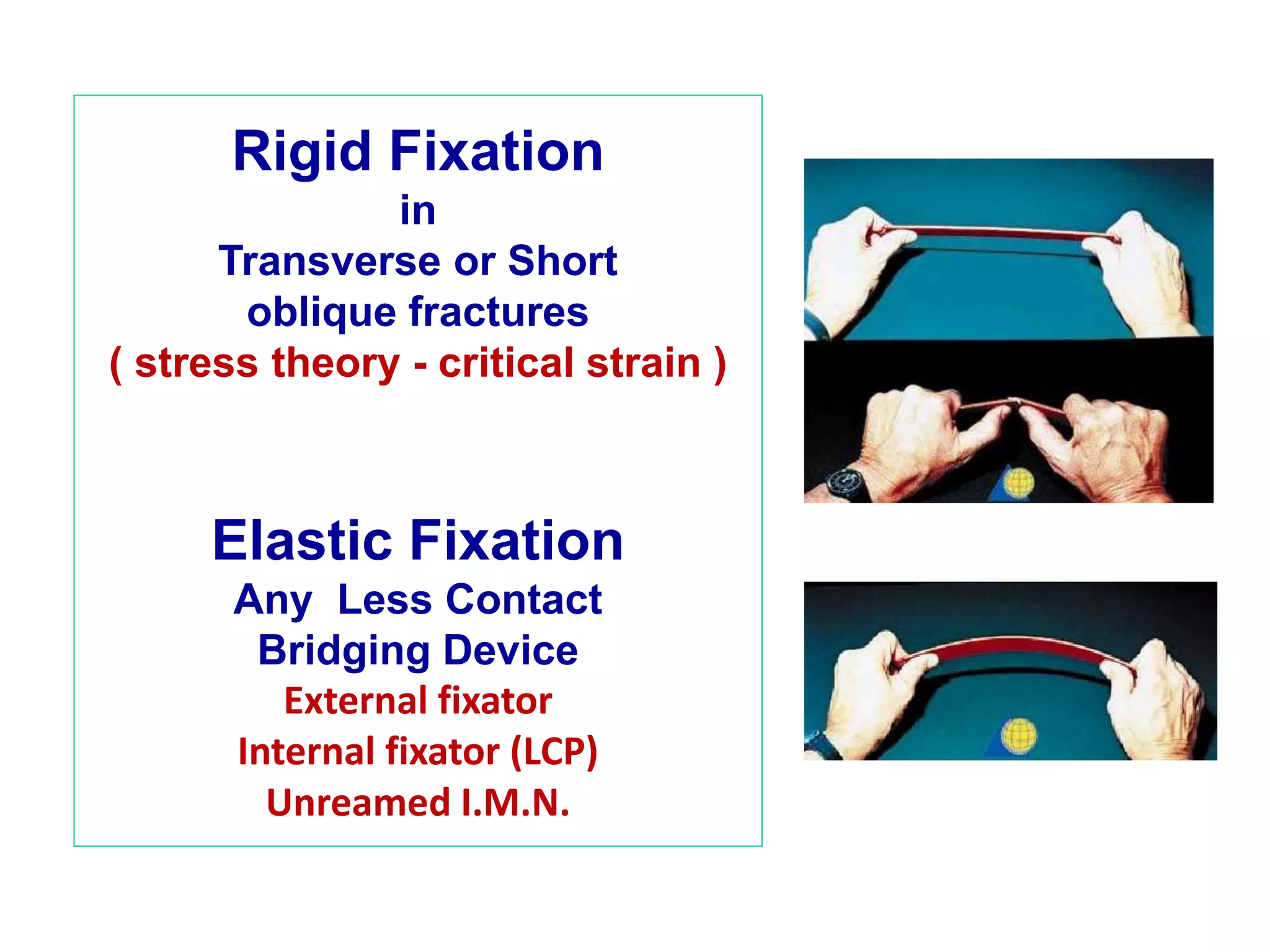 History of fracture fixation part 2 | PPTX