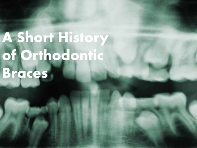 A Short History of Orthodontic Braces | PPTX | Dental Health | Diseases ...