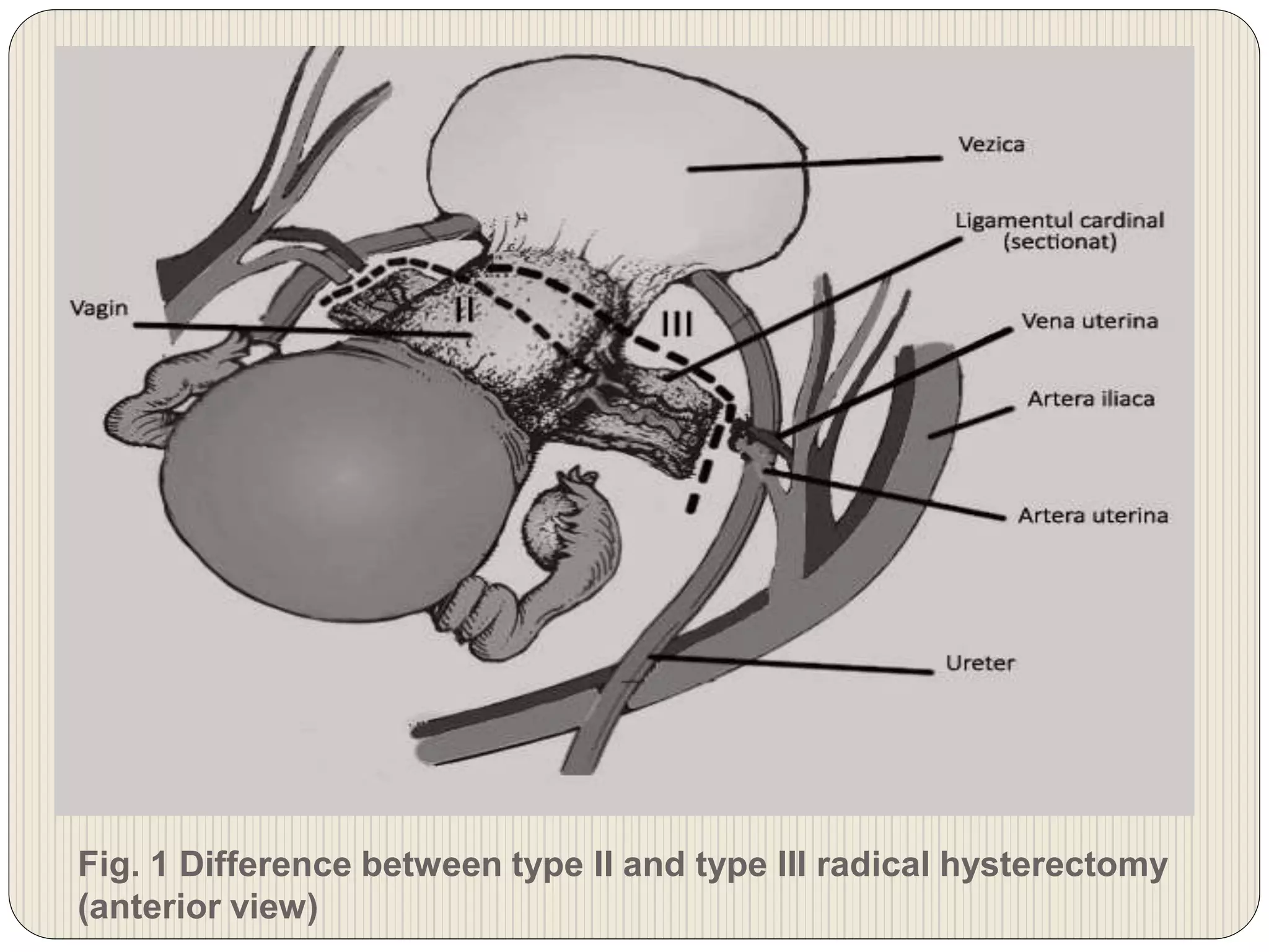 History of radical hysterectomy for cancer cervix | PPTX