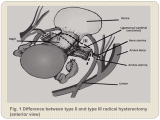 History of radical hysterectomy for cancer cervix | PPTX