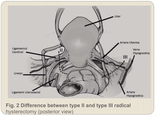 History of radical hysterectomy for cancer cervix | PPTX