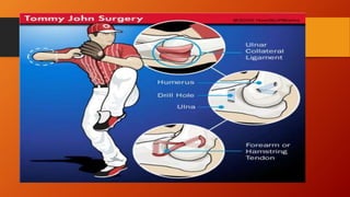 History of Tommy John Surgery | PPTX
