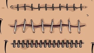 History Suture and how it has impact on surgery | PPT