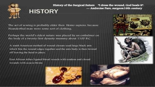 History Suture and how it has impact on surgery | PPT