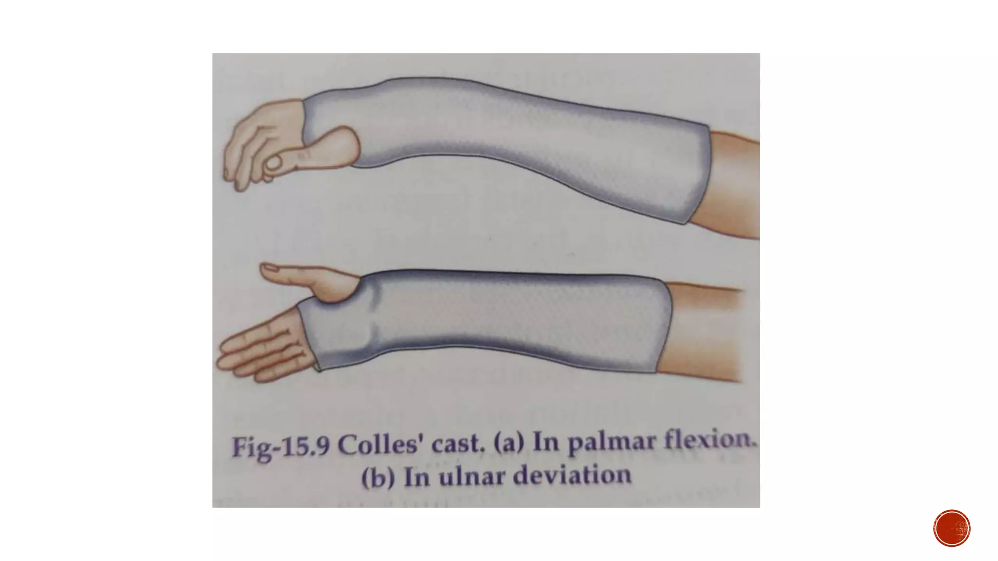 history taking and colles fracture.pptx