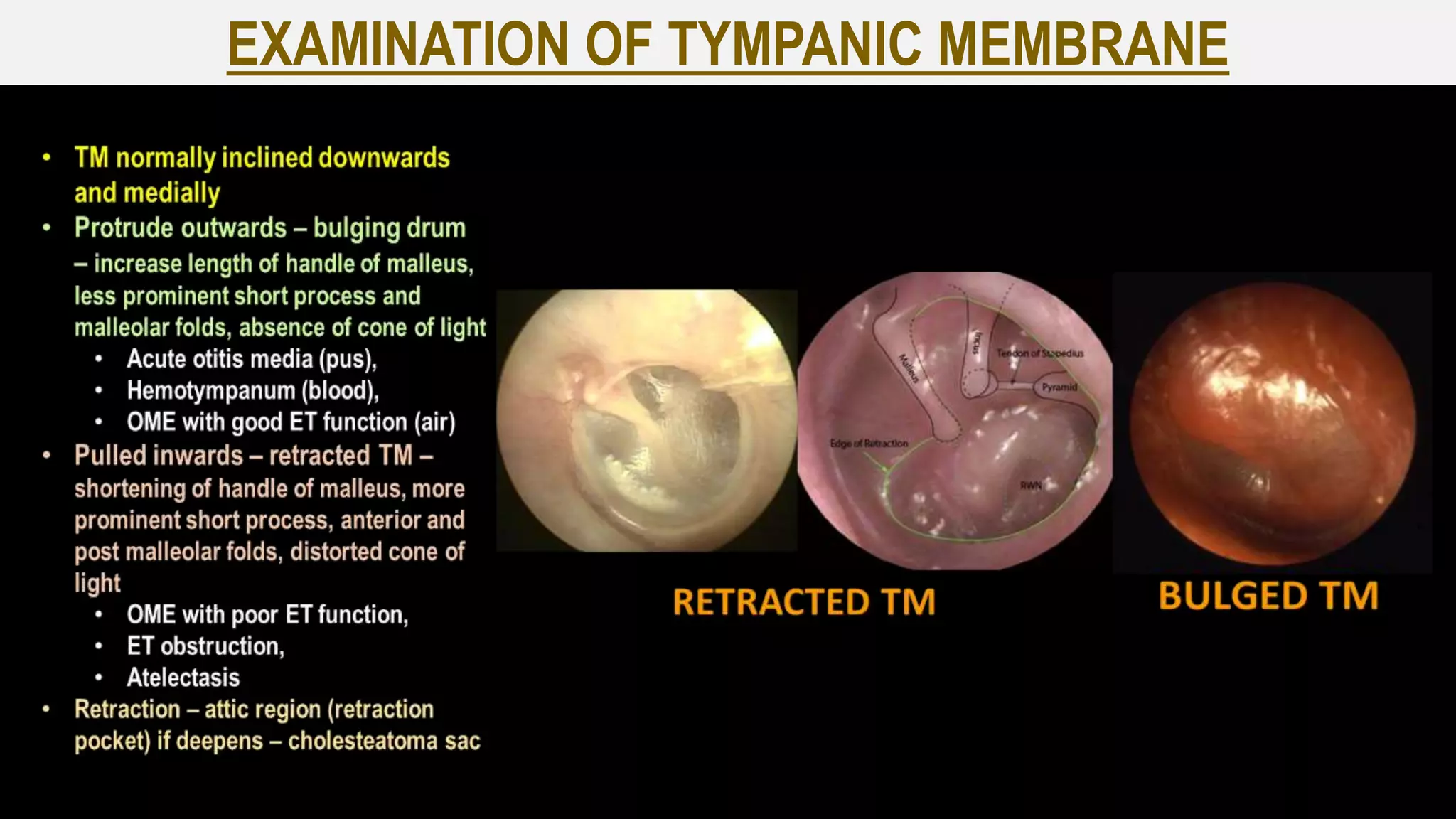 History taking in a case of CSOM with central perforation | PPTX