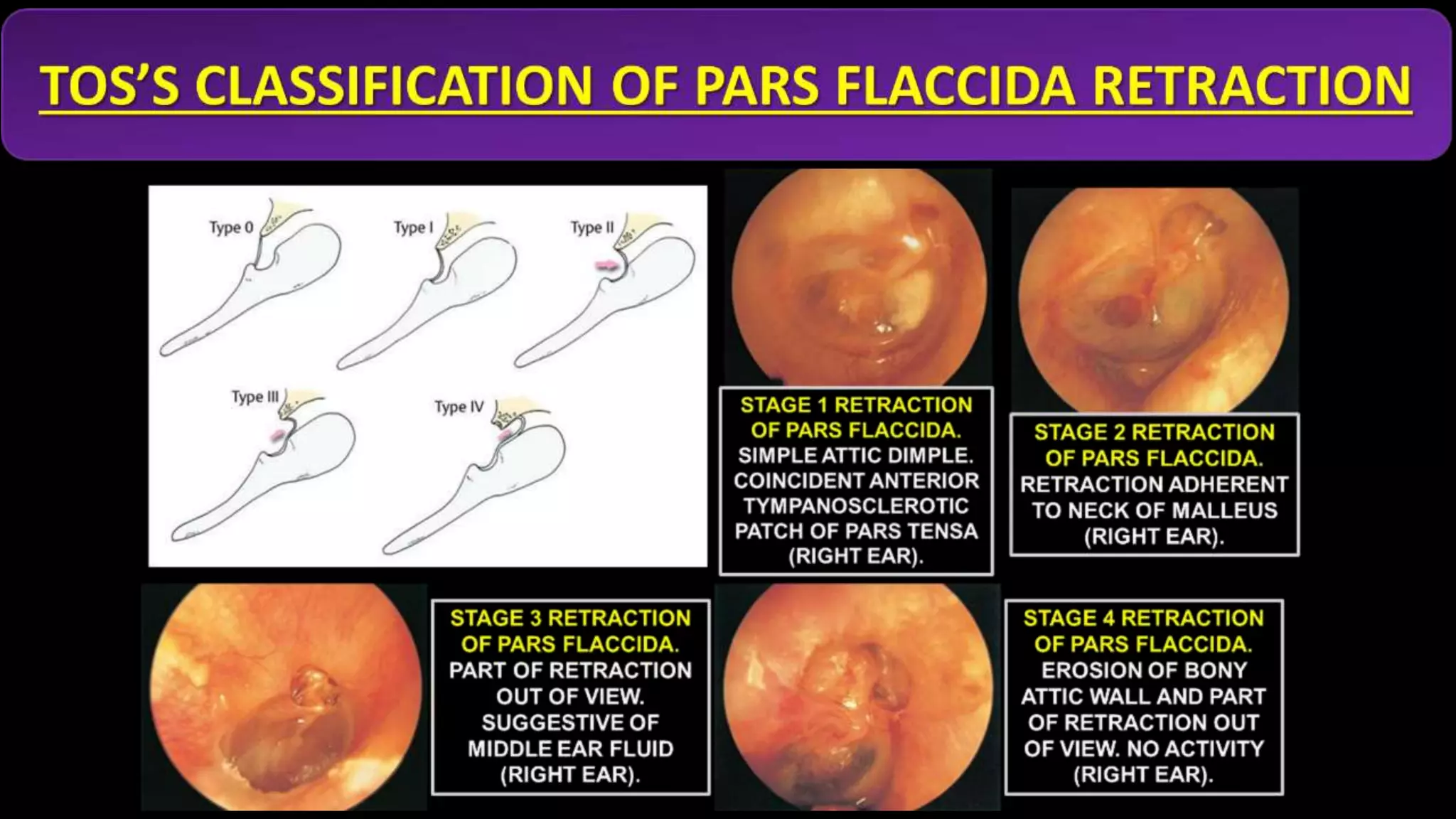 History taking in a case of CSOM with central perforation | PPTX