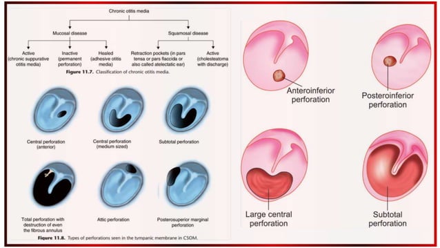 History taking in a case of CSOM with central perforation | PPTX | Ear ...