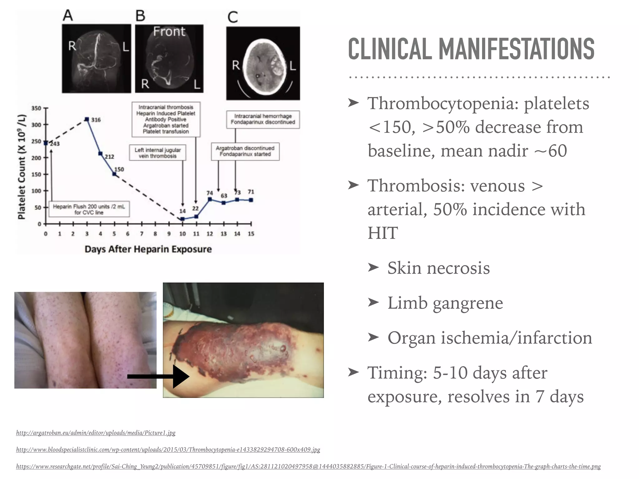 Heparin Induced Thrombocytopenia | PDF