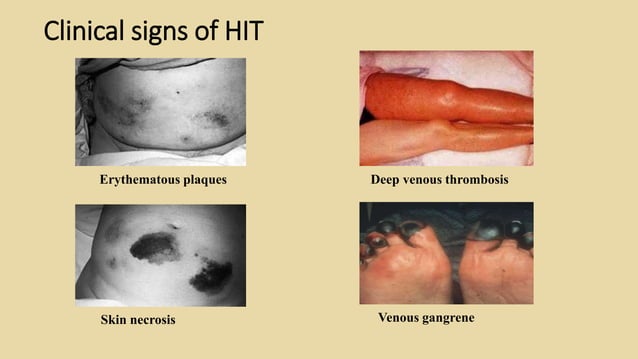 Heparin Induced Thrombocytopeia (HIT) | PPT